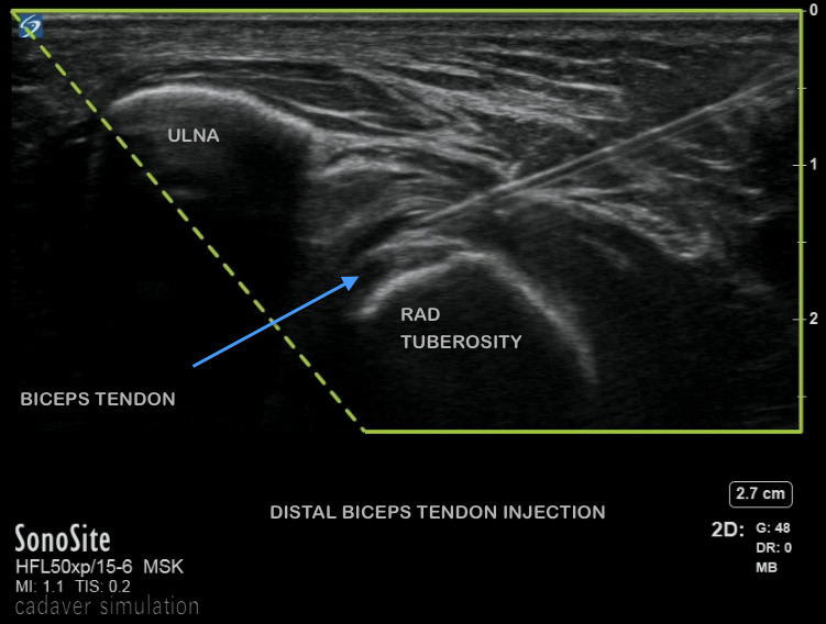 Elbow: Distal Biceps Tendon Injection | Sonosite