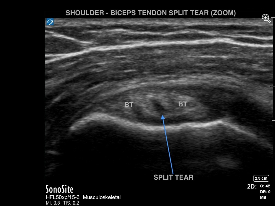 Shoulder: ZOOM Biceps Tendon Split Tear | Sonosite