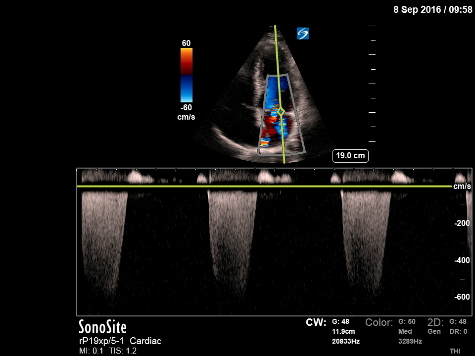 XP rP19 - Área apical cardíaca, corte 4 cámaras con CW | FUJIFILM Sonosite